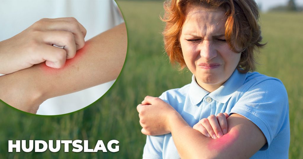 Hudutslag - Olika Typer av Utslag - Symtom & Behandling